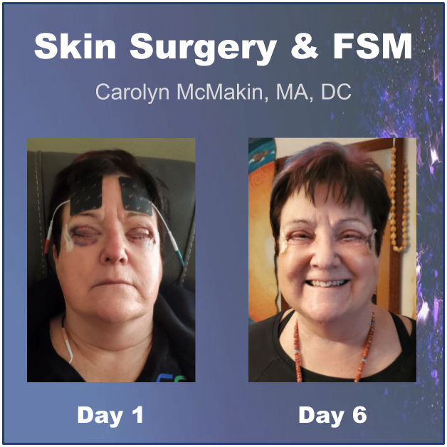 Skin Surgery - Frequency Specific Microcurrent Skin Surgery - Frequency Specific Microcurrent
